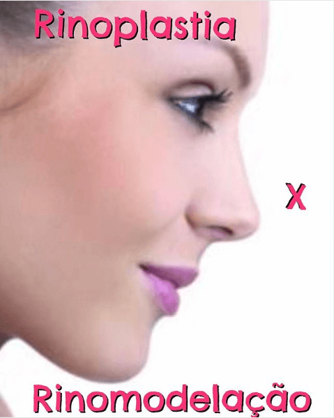 Rinomodelação X Rinoplastia Dra Danielle Gondim